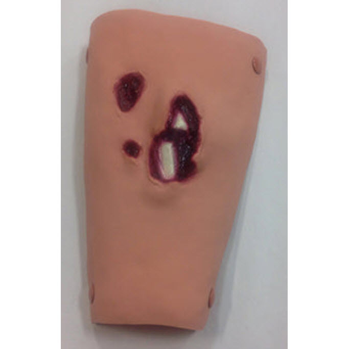 Simulaids Compound Fracture, Tibia/Lower Leg, Light Skin Tone | Bound Tree